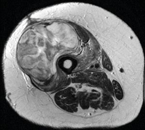 Weichteilsarkome – Diagnostik und multimodale Therapie